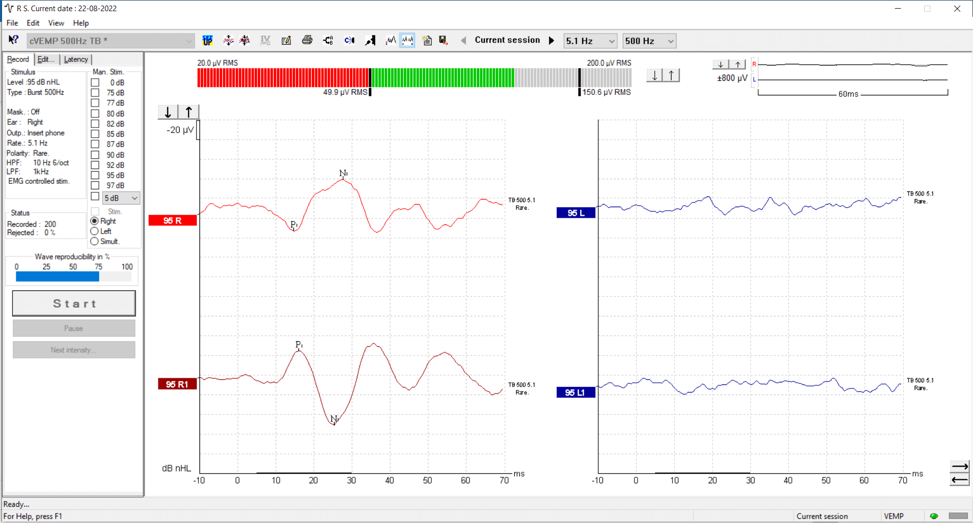Eclipse | Evoked potentials device | Interacoustics